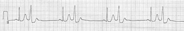 Topic - Premature Ventricular Contractions Nomenclature | 12-Lead ECG ...