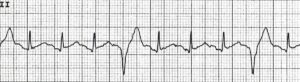 Topic - Premature Ventricular Contractions Nomenclature | 12-Lead ECG ...