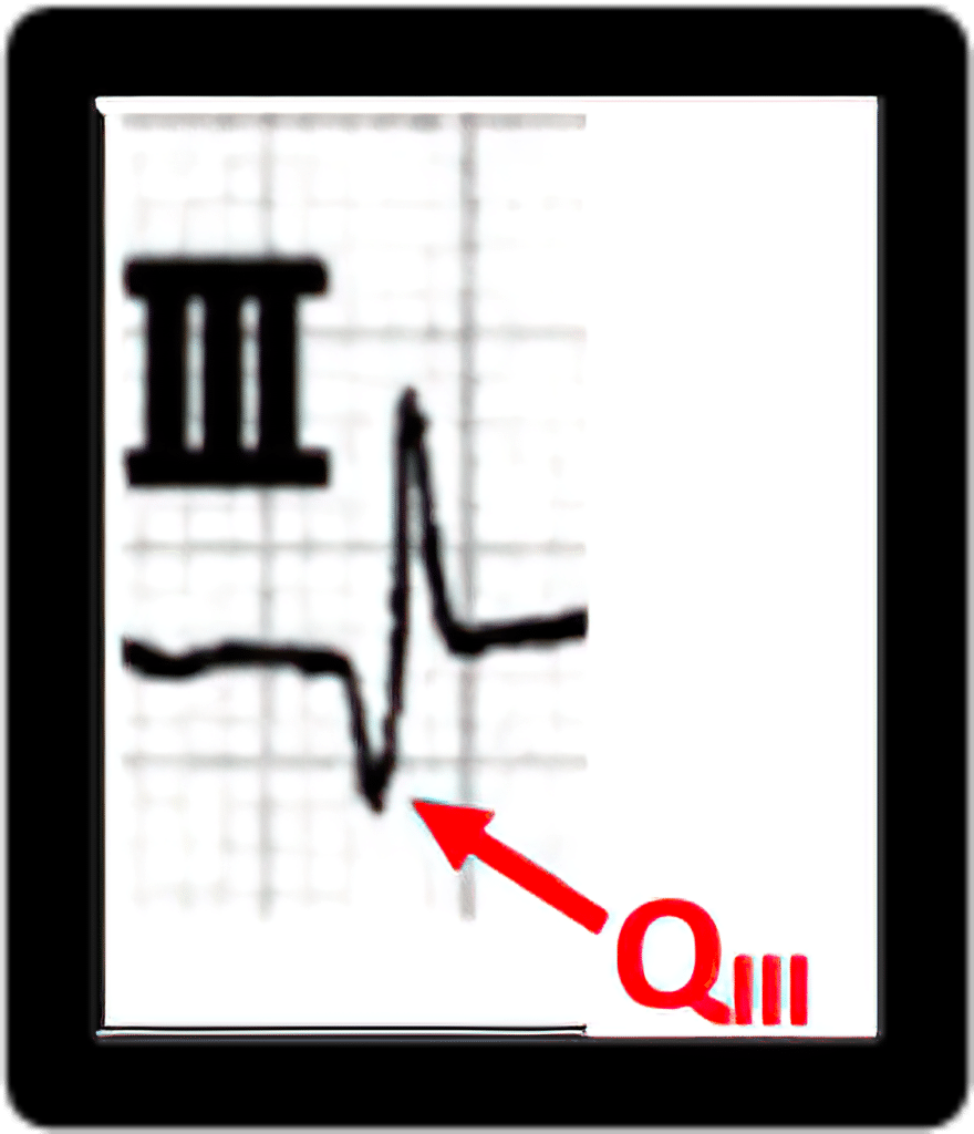 Topic - The QRS Complex | 12-Lead ECG Certification Course | ACLS ...