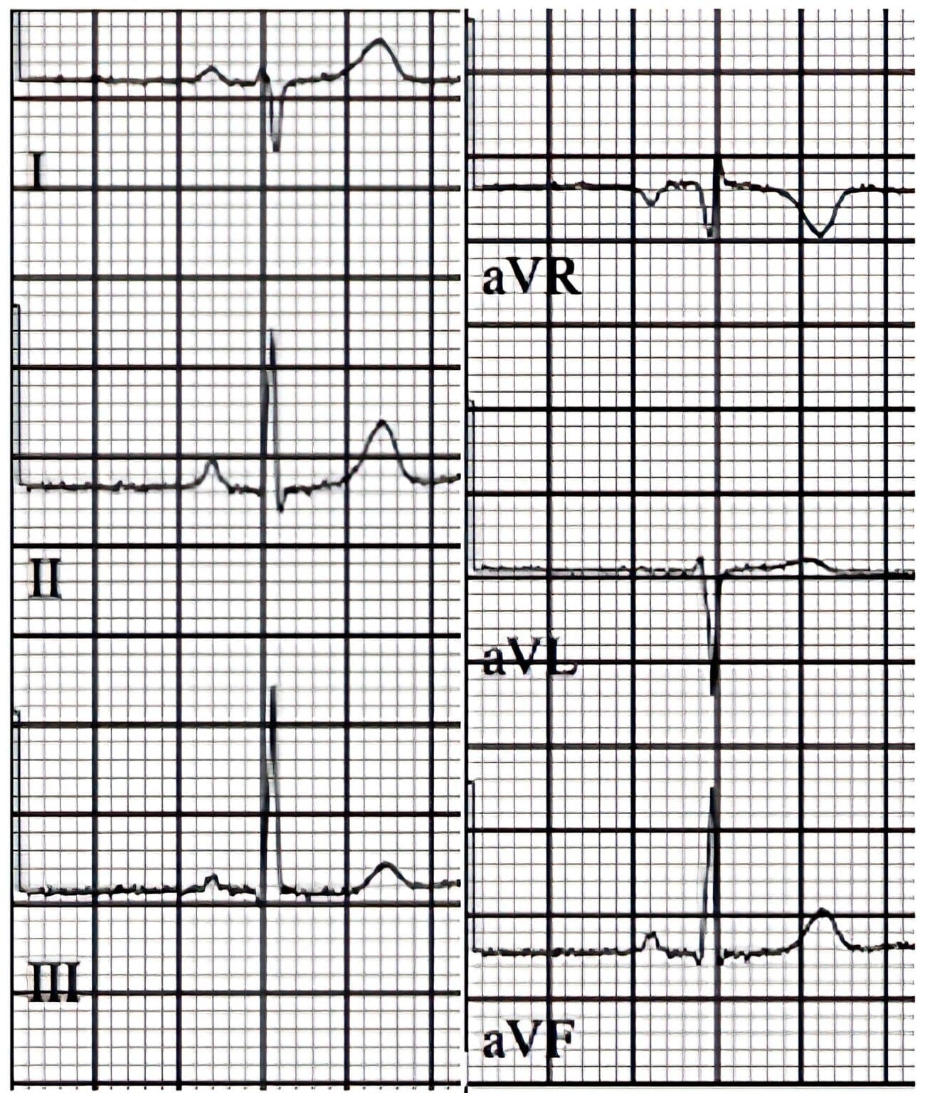 Topic - The Cardiac Axis | 12 Lead ECG Course | ACLS Certification ...