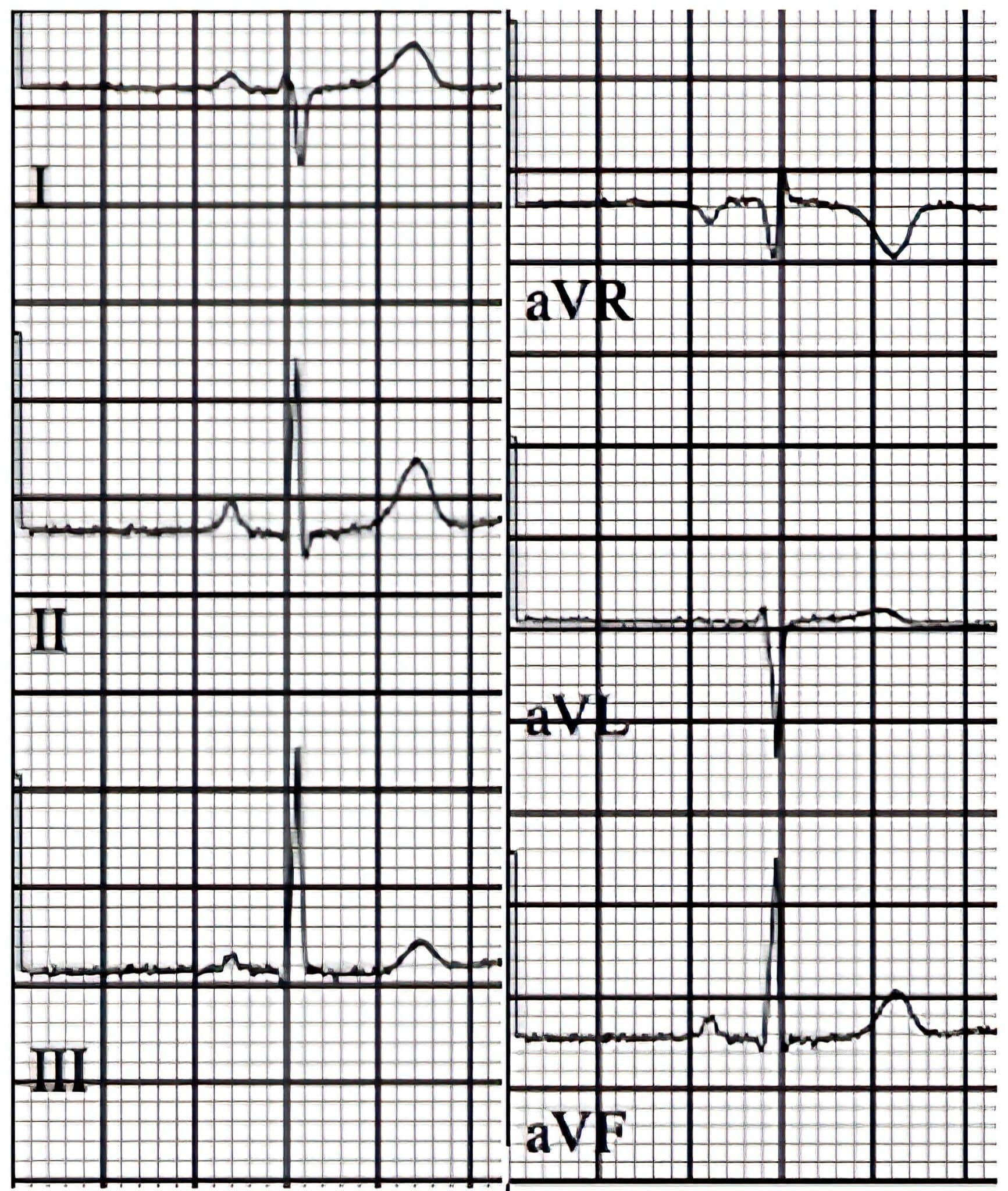Topic - The Cardiac Axis | 12 Lead ECG Course | ACLS Certification ...