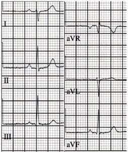 Topic - The Cardiac Axis | 12 Lead ECG Course | ACLS Certification ...