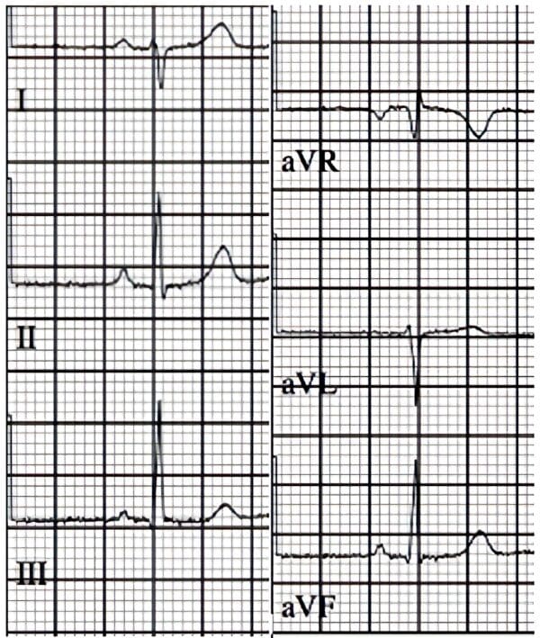 Topic - The Cardiac Axis | 12 Lead ECG Course | ACLS Certification ...