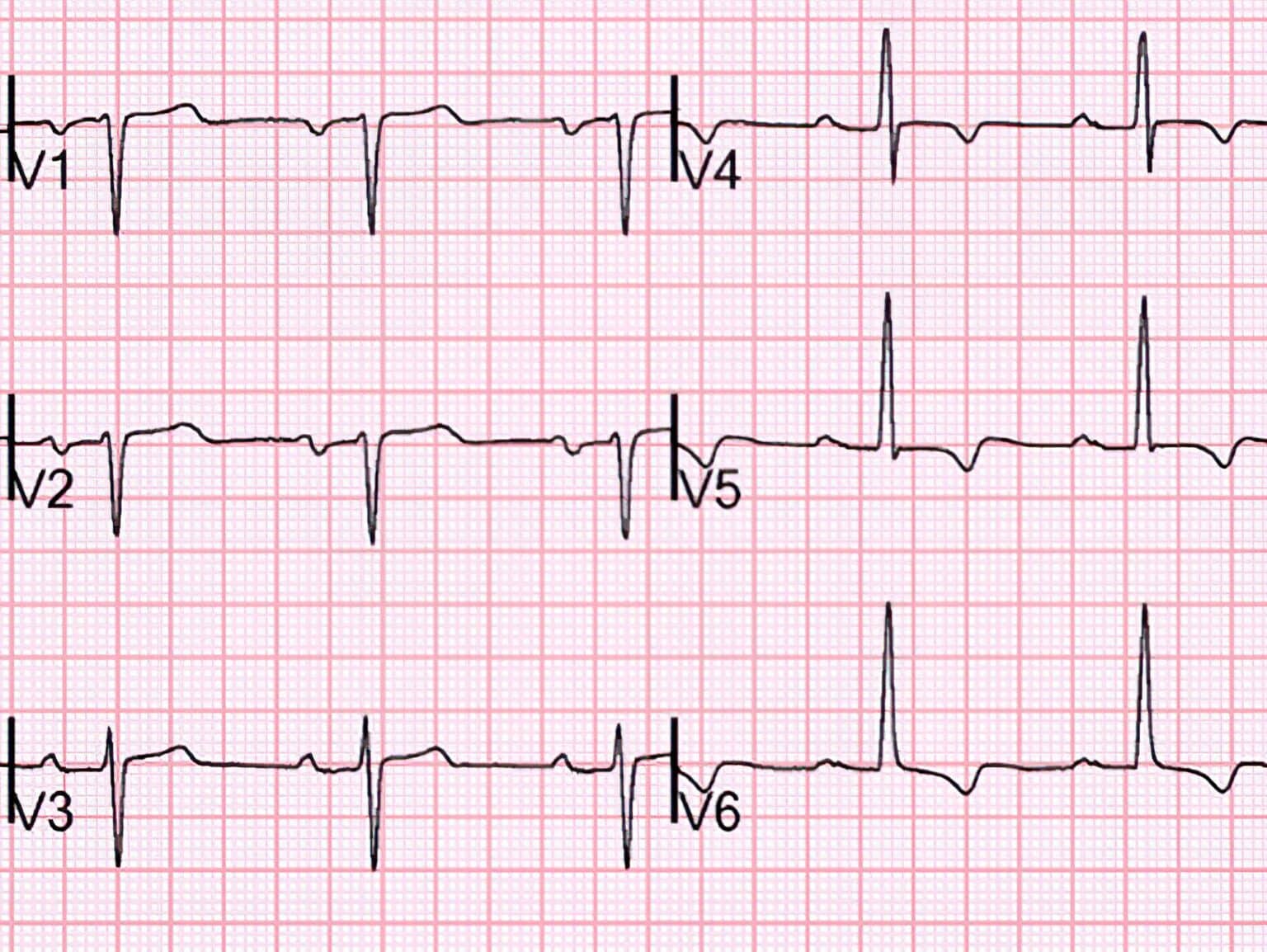Topic - The QRS Complex | 12-Lead ECG Certification Course | ACLS ...