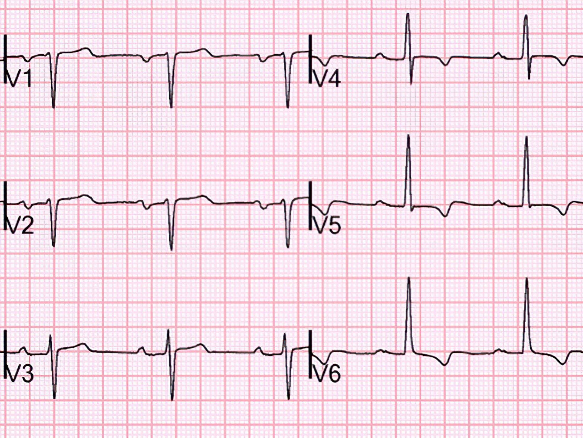 Topic - The QRS Complex | 12-Lead ECG Certification Course | ACLS ...
