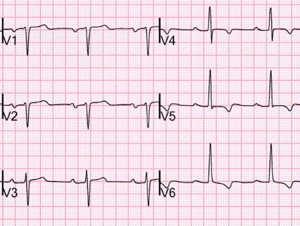 Topic - The QRS Complex | 12-Lead ECG Certification Course | ACLS ...