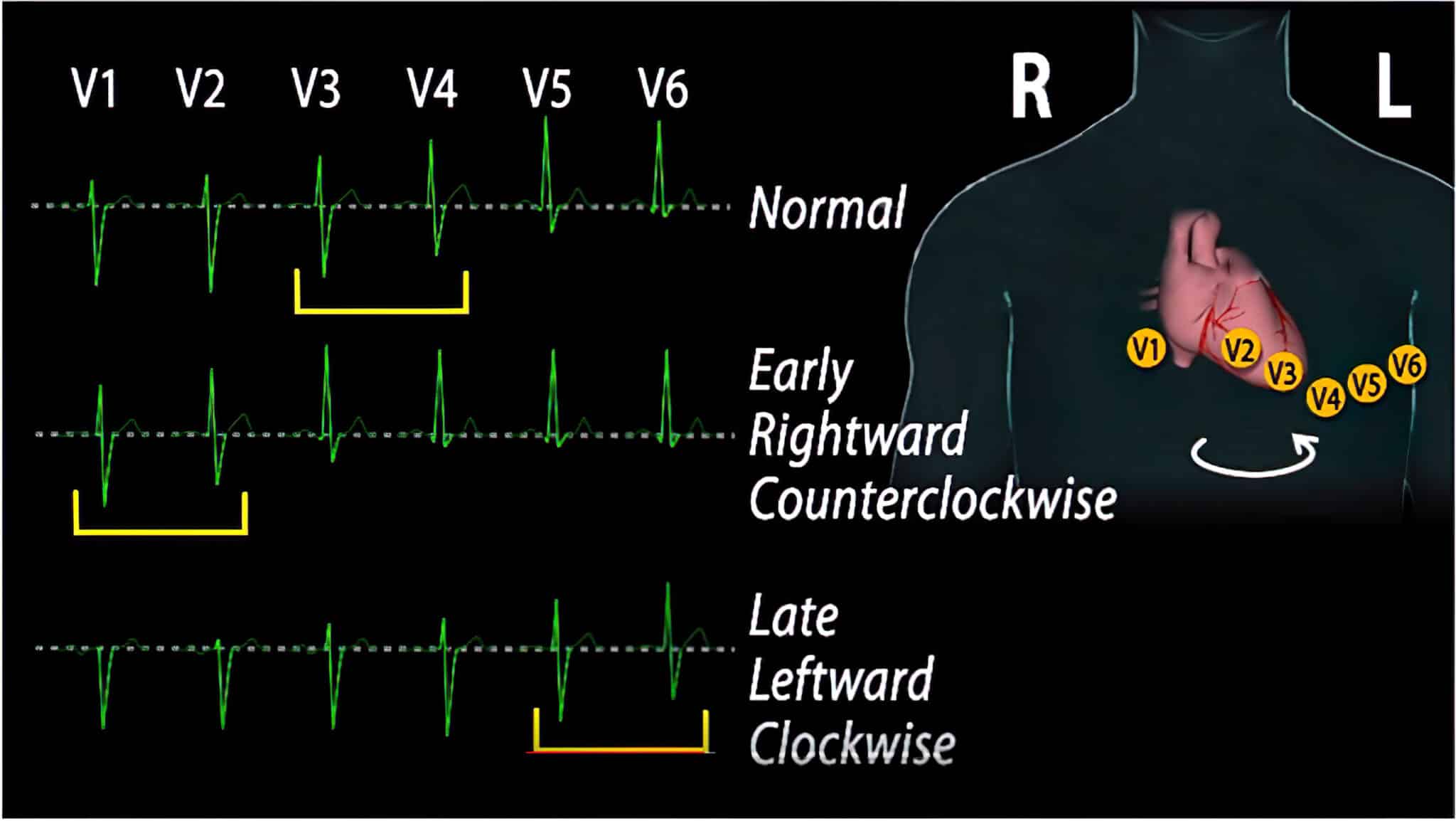Topic - The QRS Complex | 12-Lead ECG Certification Course | ACLS ...