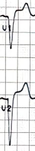 Topic - The QRS Complex | 12-Lead ECG Certification Course | ACLS ...