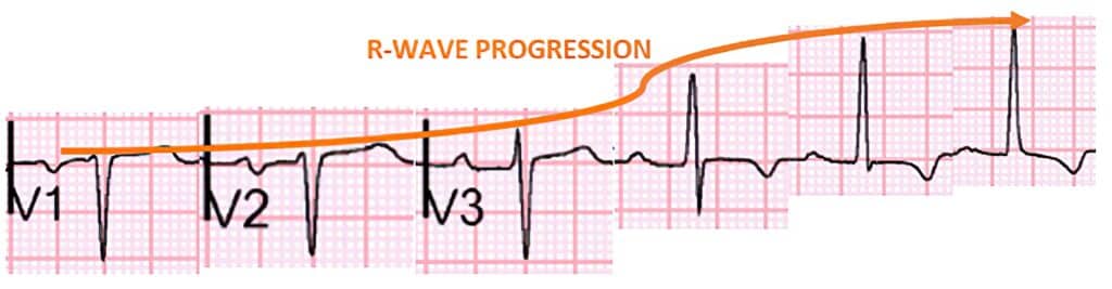 Topic - The QRS Complex | 12-Lead ECG Certification Course | ACLS ...