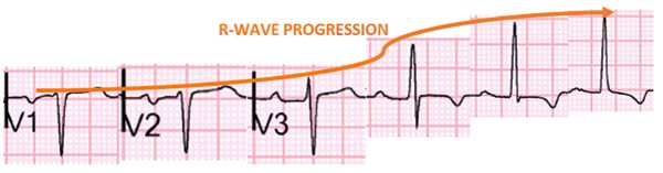 Topic - The QRS Complex | 12-Lead ECG Certification Course | ACLS ...