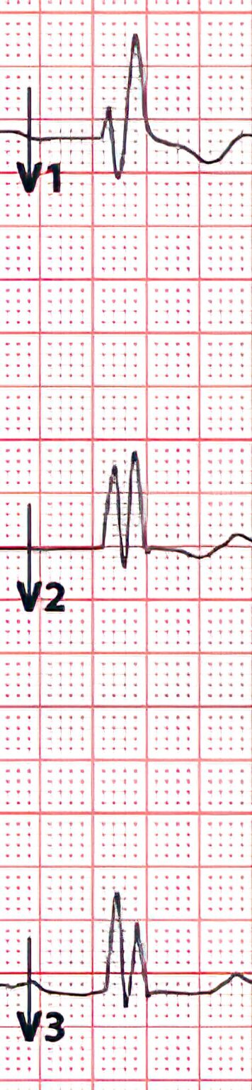 Topic - Rhythm Analysis | 12-Lead ECG Certification Course | ACLS ...