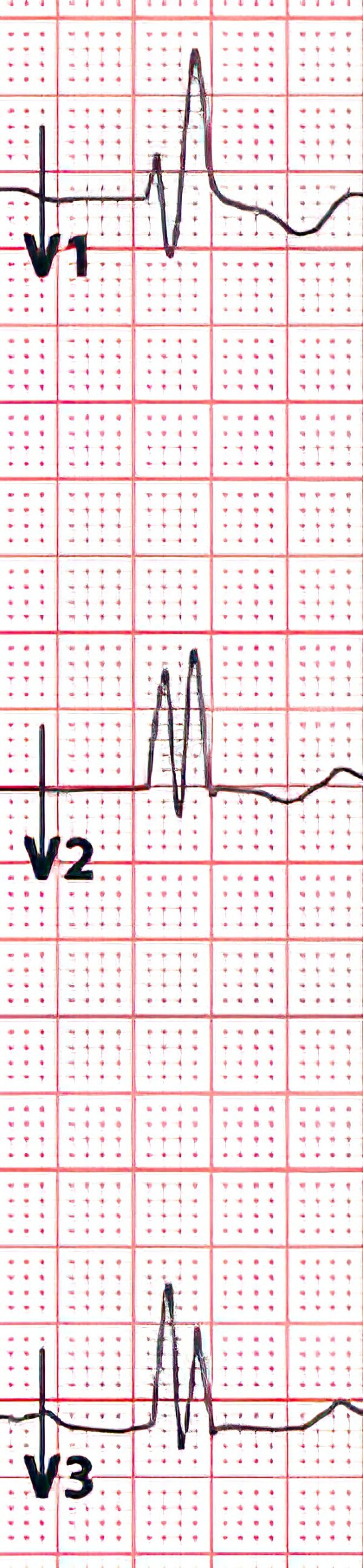 Topic - Rhythm Analysis | 12-Lead ECG Certification Course | ACLS ...