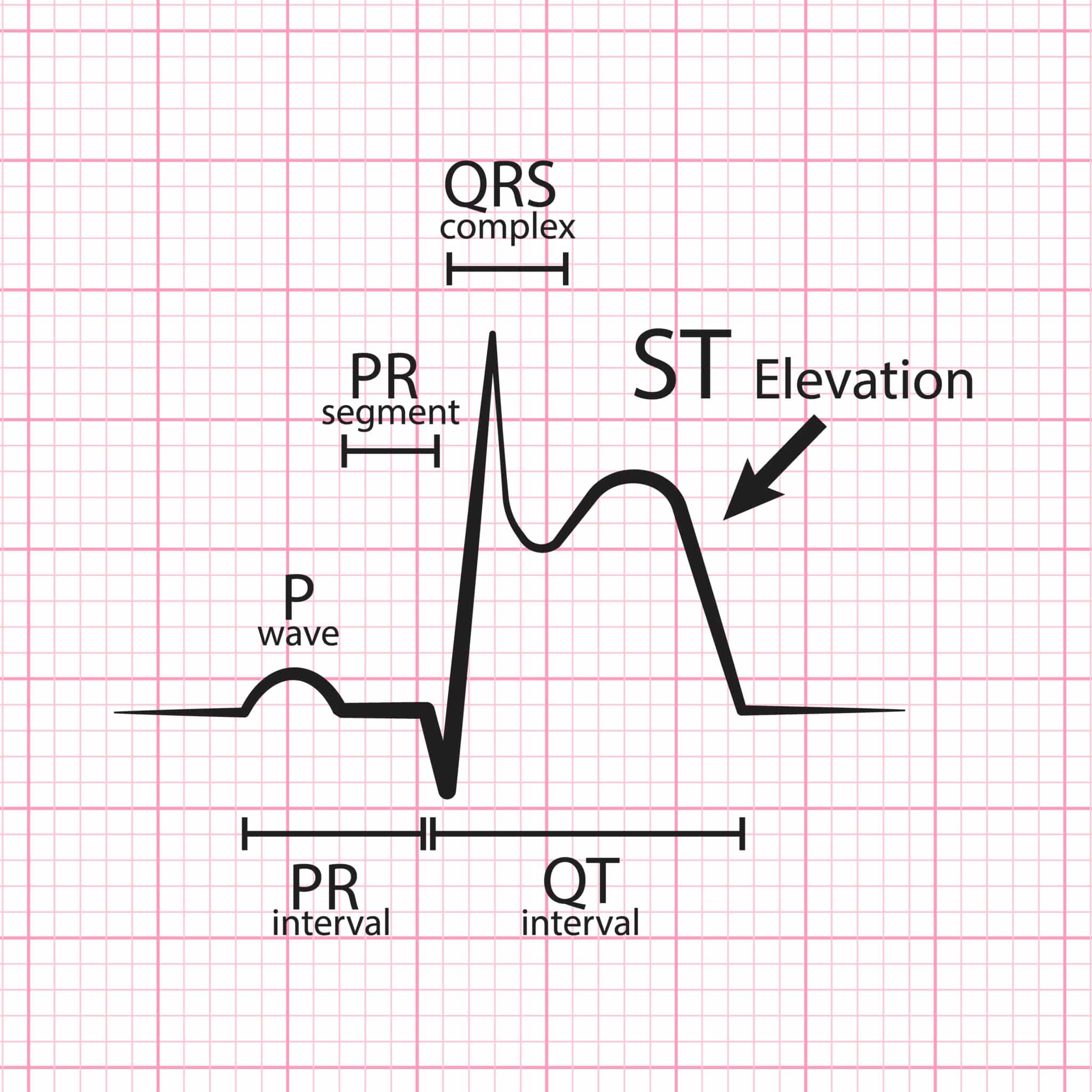 Topic - Changes in the ST Segment | 12 Lead ECG Course | ACLS Certification Association
