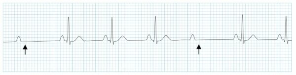 Topic - Second-Degree Atrioventricular Block, Mobitz Type II | 12-Lead ...