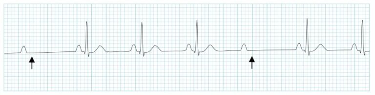 Topic - Second-Degree Atrioventricular Block, Mobitz Type II | 12-Lead ...