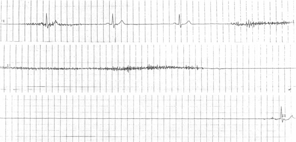 Topic - Electrocardiogram Characteristics of Sinus Node Dysfunction ...