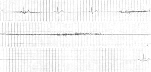 Topic - Electrocardiogram Characteristics of Sinus Node Dysfunction ...