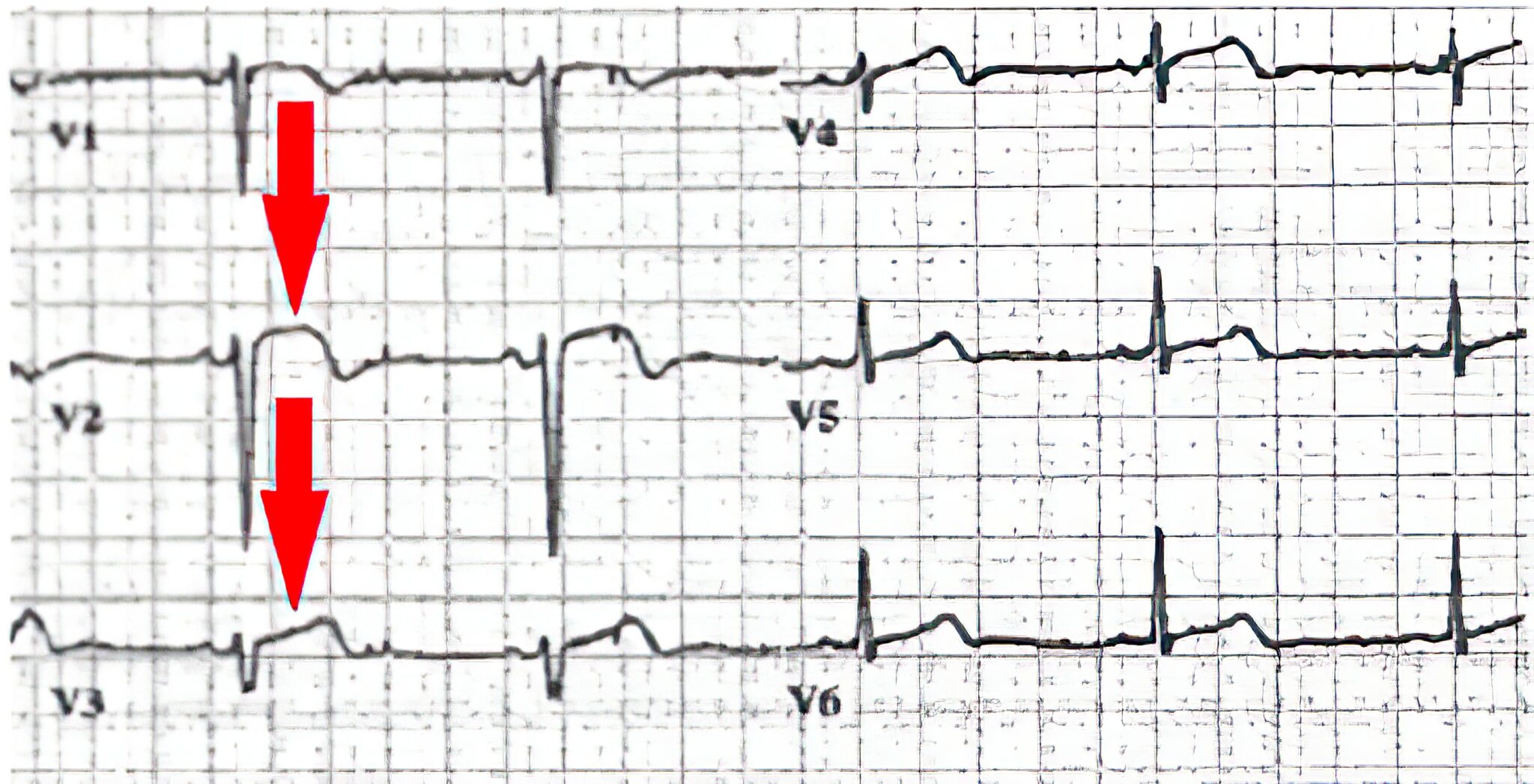 Topic - The ST Segment | 12 Lead ECG Course | ACLS Certification ...