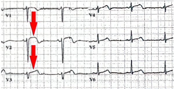 Topic - The ST Segment | 12 Lead ECG Course | ACLS Certification ...
