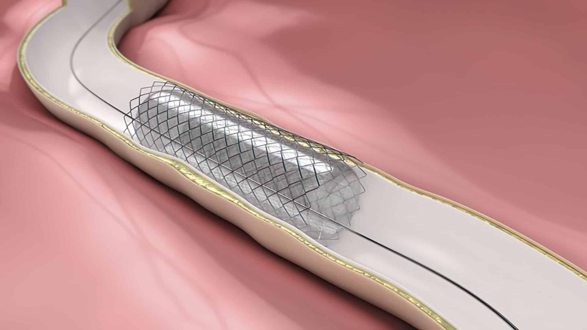 Topic - Checklist for Fibrinolytic Therapy | ACLS Course | ACLS ...