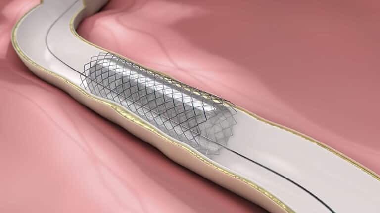 Topic - Checklist for Fibrinolytic Therapy | ACLS Course | ACLS ...