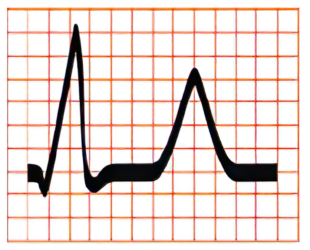 Topic - T and ST Wave Changes in Ischemia | 12-Lead ECG Certification ...