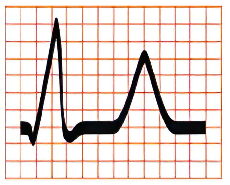 Topic - T and ST Wave Changes in Ischemia | 12-Lead ECG Certification ...
