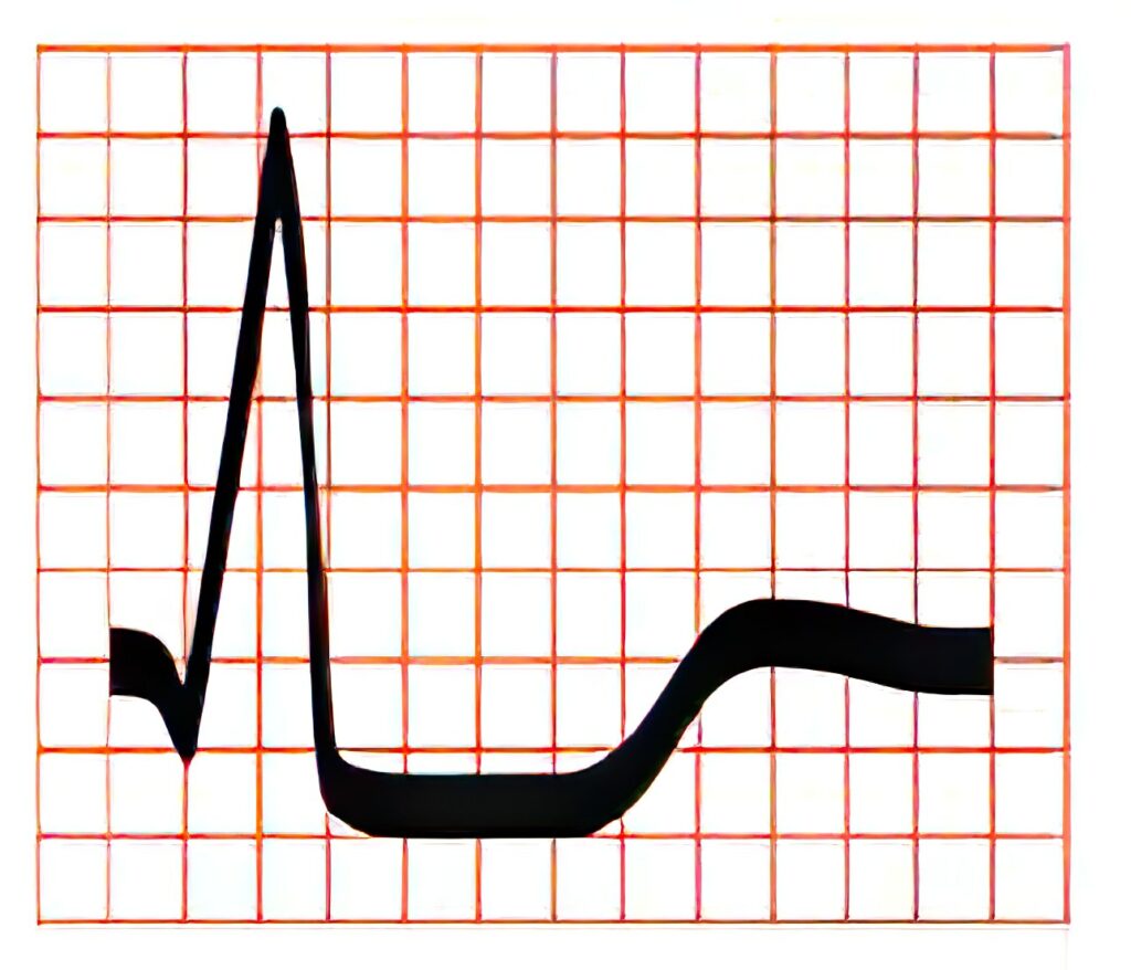 Topic - T and ST Wave Changes in Ischemia | 12-Lead ECG Certification ...