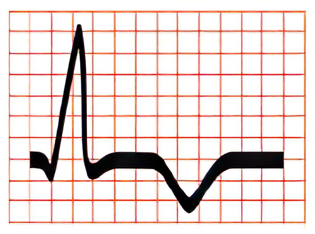 Topic - T and ST Wave Changes in Ischemia | 12-Lead ECG Certification ...