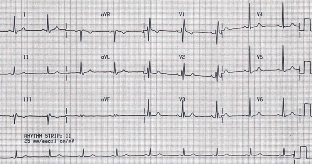Topic - Definitive Electrocardiogram Diagnosis | 12-Lead ECG ...