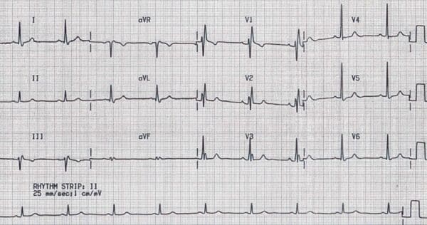 Topic - Definitive Electrocardiogram Diagnosis | 12 Lead ECG Course ...