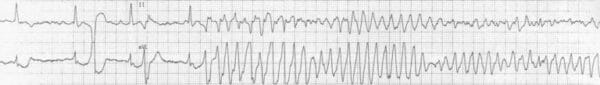 Topic - Types of Ventricular Tachycardia | 12-Lead ECG Certification ...