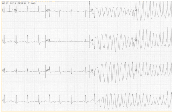 Topic - Types of Ventricular Tachycardia | 12-Lead ECG Certification ...