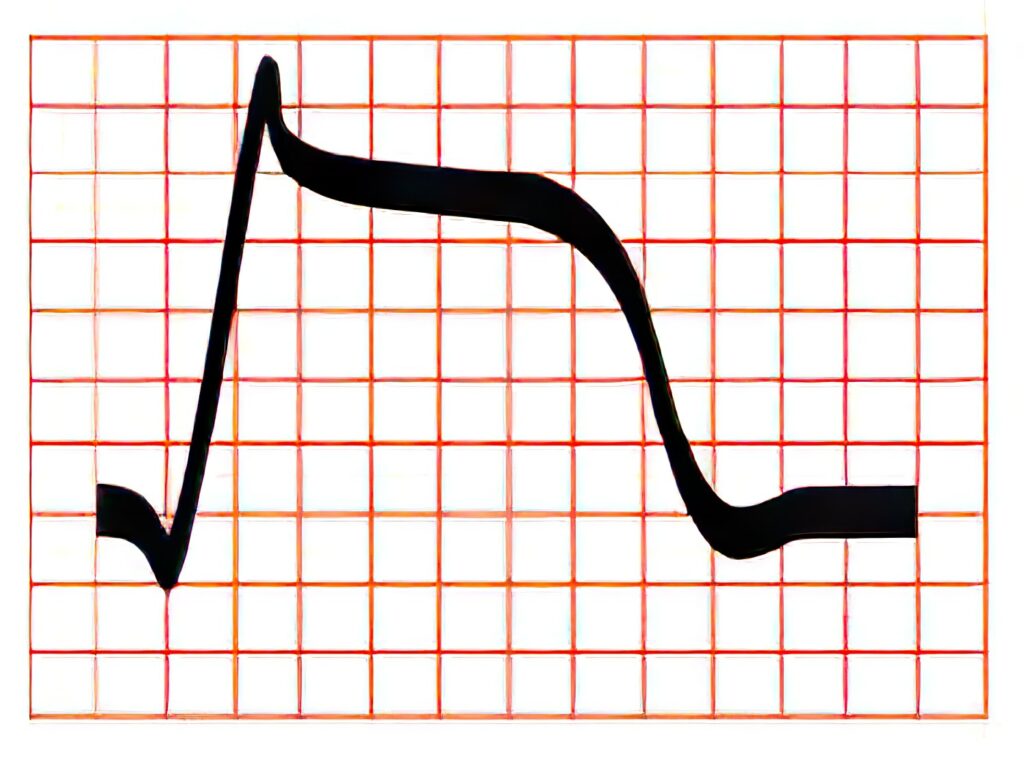Topic - T and ST Wave Changes in Ischemia | 12-Lead ECG Certification ...