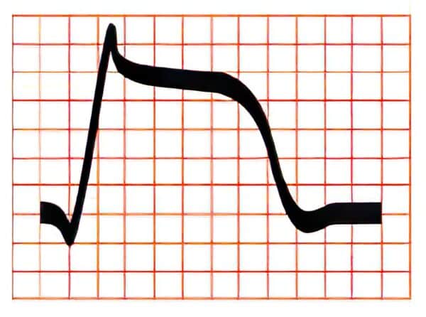 Topic - T and ST Wave Changes in Ischemia | 12-Lead ECG Certification ...