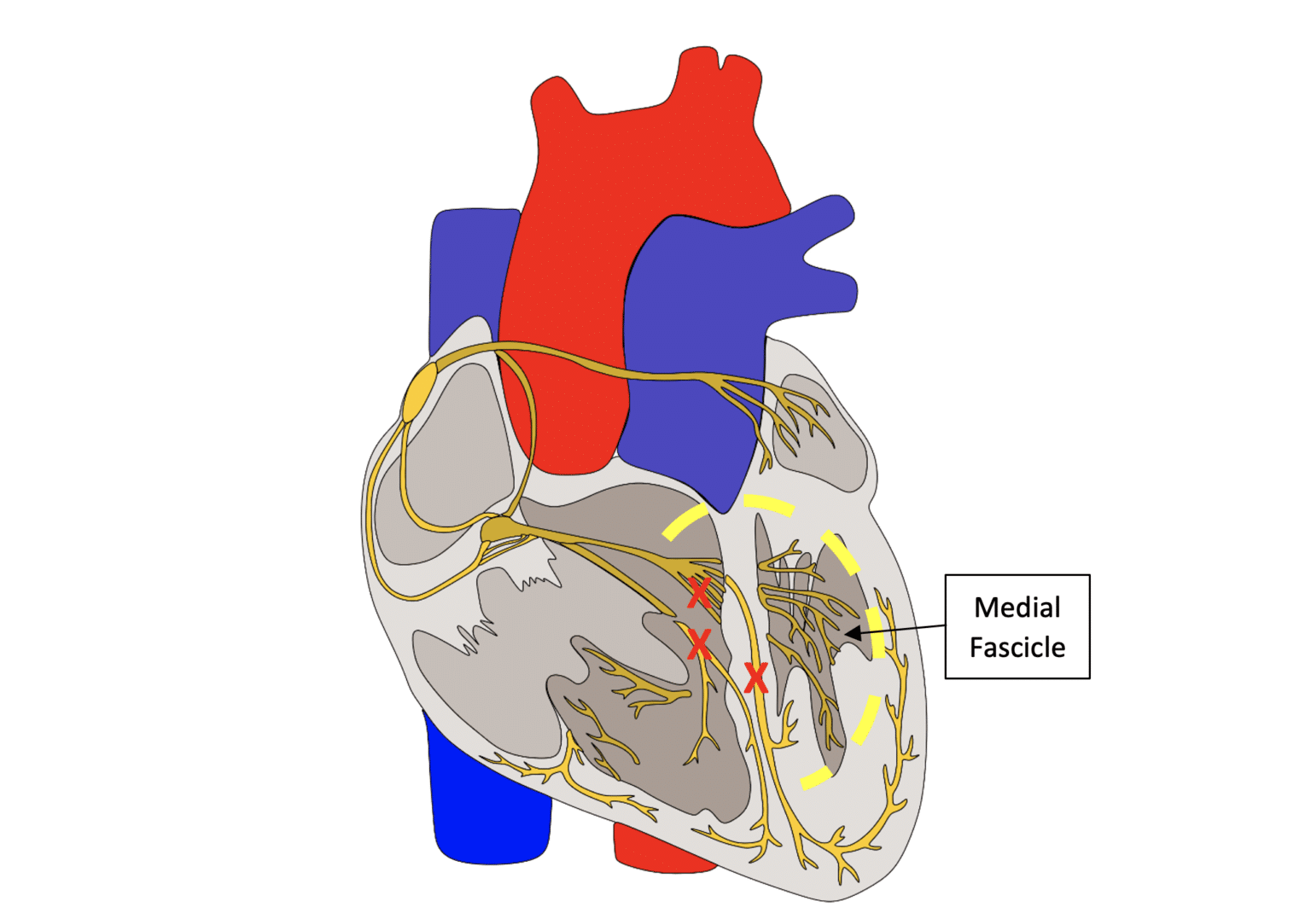 Topic - Trifascicular Block (RBBB + LAFB + LPFB) | 12-Lead ECG ...