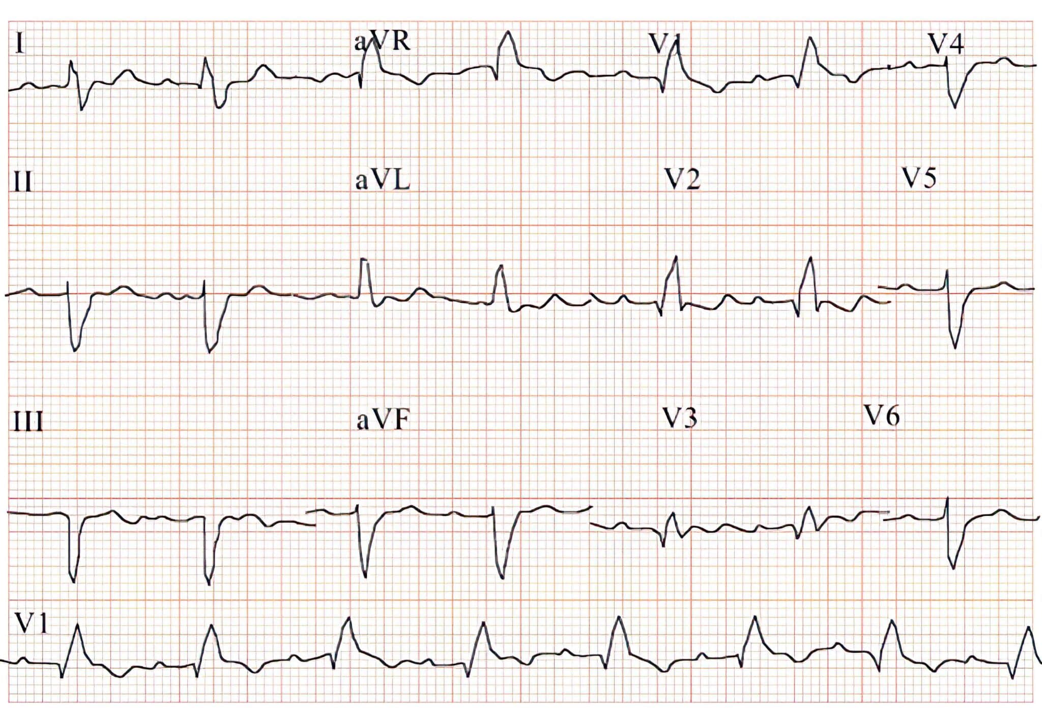 Topic - Trifascicular Block (RBBB + LAFB + LPFB) | 12-Lead ECG ...