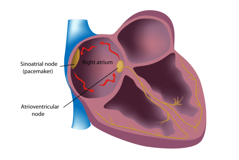 Topic - Atrial Flutter | 12 Lead ECG Course | ACLS Certification ...