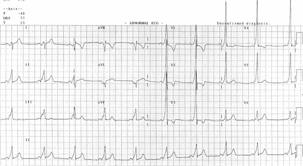 Topic - Types of Wolff-Parkinson-White Syndrome | 12-Lead ECG ...