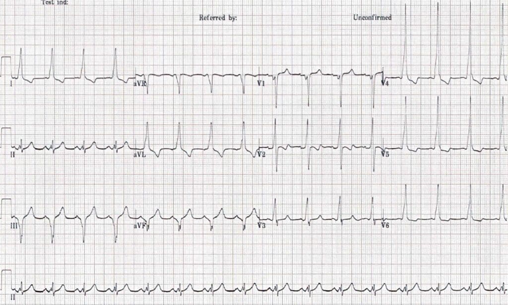 Topic - Differential Diagnosis of Wolff-Parkinson-White Syndrome | 12 ...