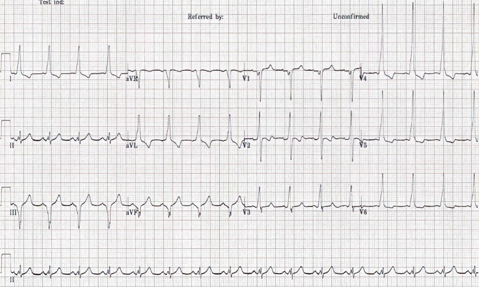 Topic - Differential Diagnosis of Wolff-Parkinson-White Syndrome | 12 ...
