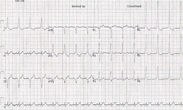Topic - Differential Diagnosis of Wolff-Parkinson-White Syndrome | 12 ...
