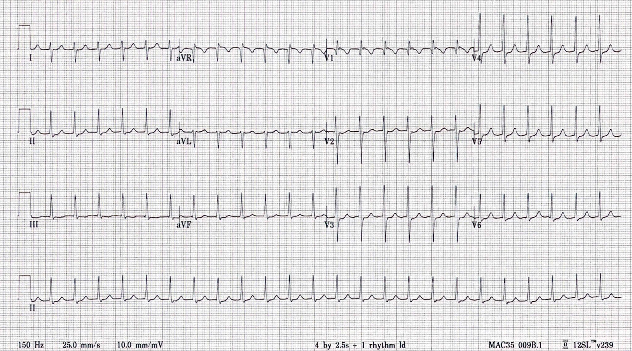 Topic - Treatment of AVNRT | 12-Lead ECG Certification Course | ACLS ...