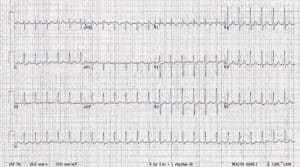 Topic - Treatment of AVNRT | 12-Lead ECG Certification Course | ACLS ...