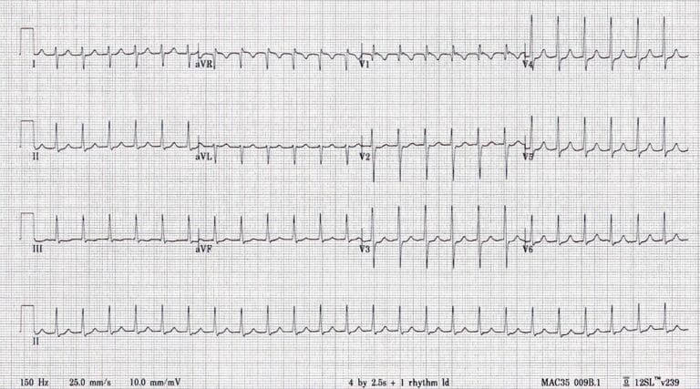 Topic - Treatment of AVNRT | 12-Lead ECG Certification Course | ACLS ...