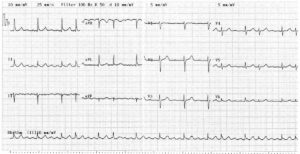 Topic - Atrial Flutter | 12 Lead ECG Course | ACLS Certification ...