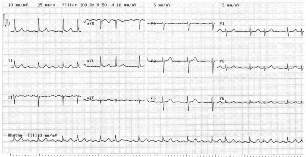 Topic - Atrial Flutter | 12 Lead ECG Course | ACLS Certification ...