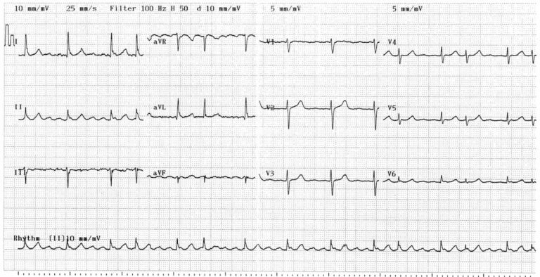 Topic - Atrial Flutter | 12 Lead ECG Course | ACLS Certification ...