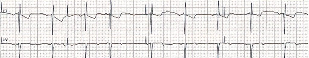 Topic - Undersensing | 12-Lead ECG Certification Course | ACLS ...