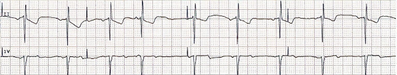 Topic - Undersensing | 12-Lead ECG Certification Course | ACLS ...